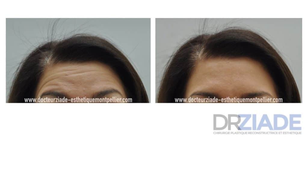 Le Botox contre les rides : front, inter-sourcils, coin de l'oeil