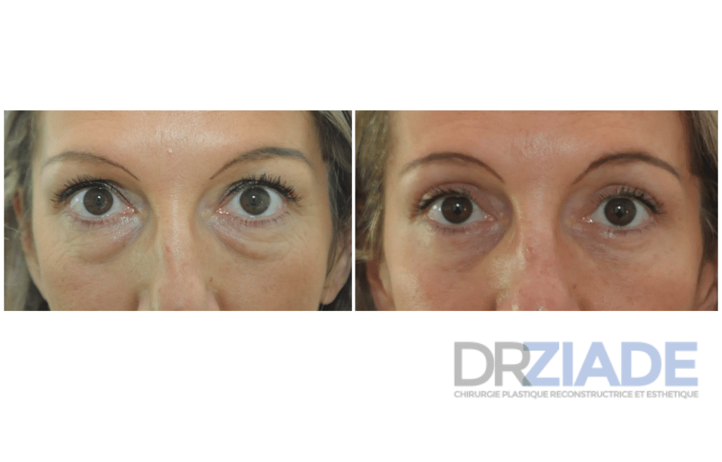 Chirurgie des paupières - Dr Ziade Chirurgie esthétique