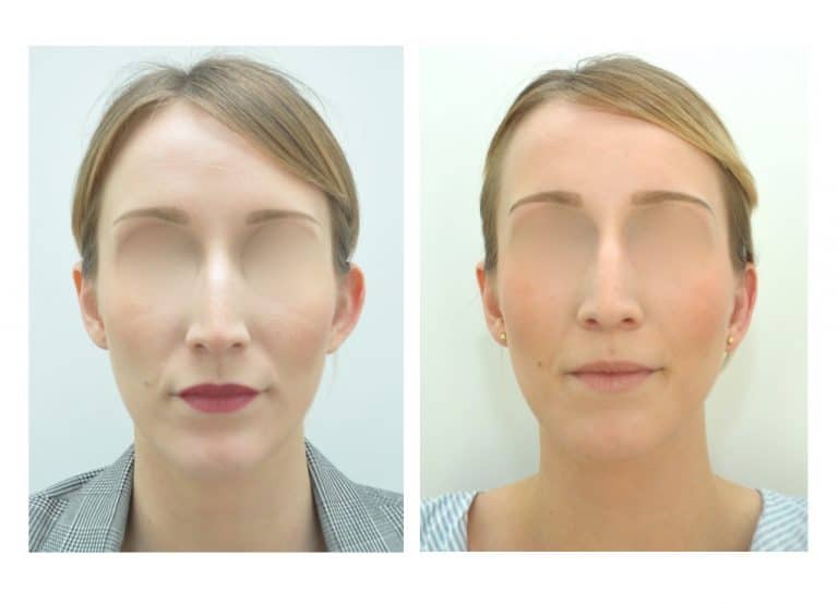 Oreilles décollées, quelle intervention pour quelle correction